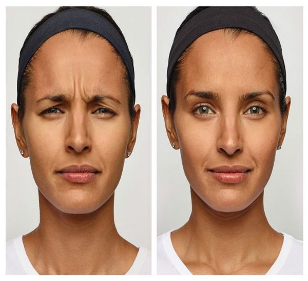 Dysport & Botox Treatment in Toronto, Canada l Refresh Your Look!
