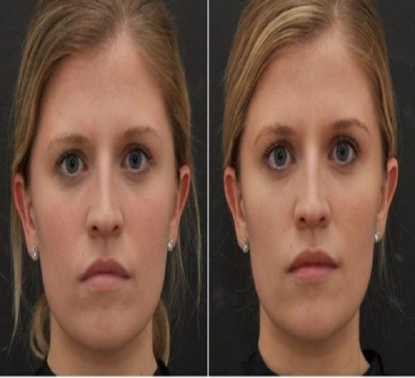 Dysport & Botox Treatment in Toronto, Canada l Refresh Your Look!