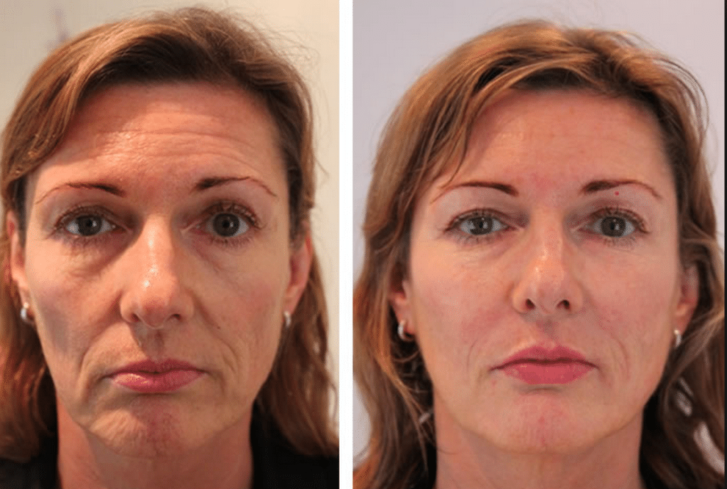Where on the Face Can BOTOX Be Injected? | VCC
