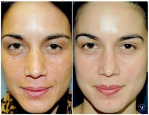 Best Chemical Peel Facial in Toronto l Peel treatment clinic