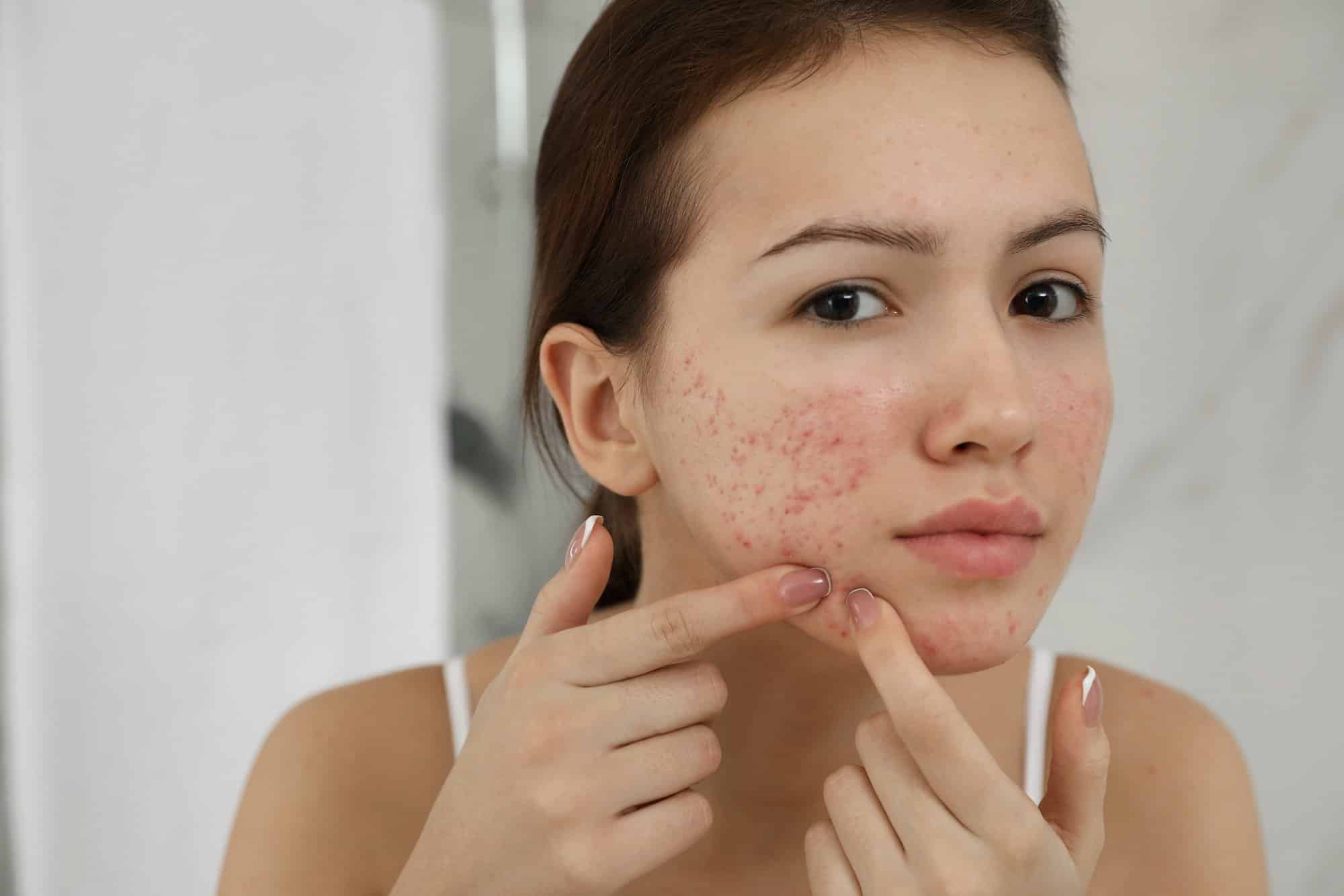 PRP Acne Scars Treatment In Toronto: Get The Best Result!