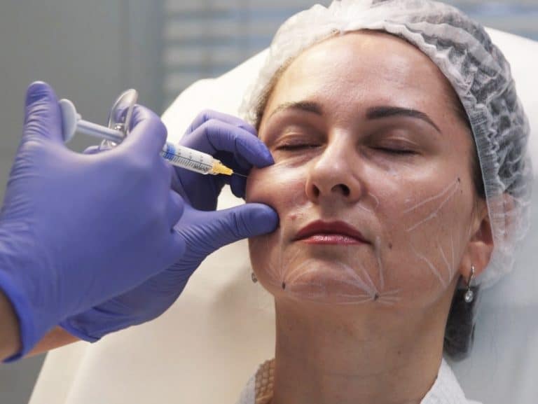 Radiesse Filler Treatment Vaughan, Canada | Radiesse Injection